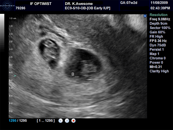 IF Optimist, then...: What the ultrasound saw…